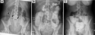 Small bowel obstruction and the gastrografin challenge | Abdominal ...