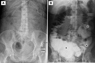 Small bowel obstruction and the gastrografin challenge | Abdominal ...