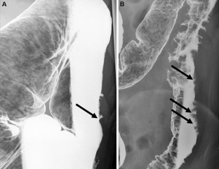 The collar button ulcer sign | SpringerLink