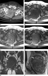 Ischiorectal fossa: benign and malignant neoplasms of this “ignored ...