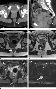 Ischiorectal fossa: benign and malignant neoplasms of this “ignored ...