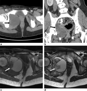 Ischiorectal fossa: benign and malignant neoplasms of this “ignored ...