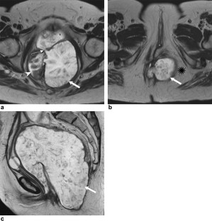 Ischiorectal fossa: benign and malignant neoplasms of this “ignored ...
