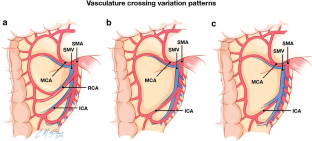 Complete mesocolic excision and central vascular ligation for right colon cancer: an ...