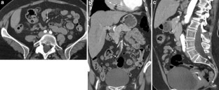 Complete mesocolic excision and central vascular ligation for right colon cancer: an ...