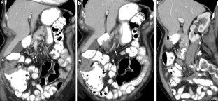 Complete mesocolic excision and central vascular ligation for right ...