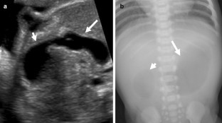 Imaging findings in association with altered maternal alpha-fetoprotein ...