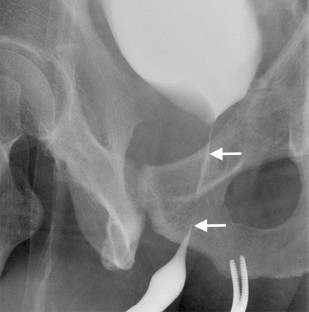 Imaging spectrum of traumatic urinary bladder and urethral injuries ...