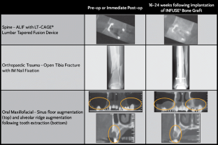 A comprehensive clinical review of recombinant human bone morphogenetic ...