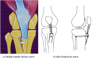 Tibial tubercle osteotomy in patello-femoral instability and in ...