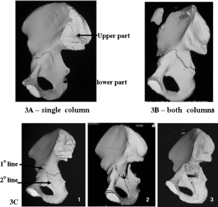 The study of broken quadrilateral surface in fractures of the ...