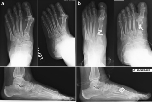 The Ludloff osteotomy: a review of current concepts | SpringerLink