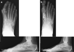 The Ludloff osteotomy: a review of current concepts | SpringerLink