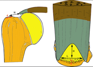 Biologic augmentation of rotator cuff repair with mesenchymal stem ...