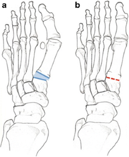 Correction power and complications of first tarsometatarsal joint arthrodesis for hallux valgus ...