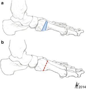 Correction power and complications of first tarsometatarsal joint arthrodesis for hallux valgus ...