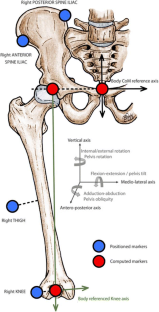 Röttinger approach with dual-mobility cup to improve functional ...