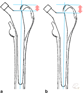 Femoral stem subsidence in cementless total hip arthroplasty: a ...