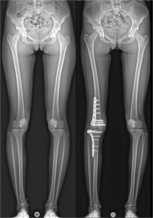 Accuracy of three dimensional-planned patient-specific instrumentation ...