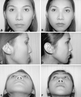 Reduction Malarplasty without External Incision: A Simple Technique ...