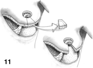 The No Vertical Scar Breast Reduction: A Minor Variation That Allows to ...