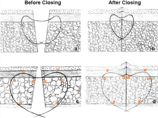 Wedge-Shaped Excision and Modified Vertical Mattress Suture Fully ...
