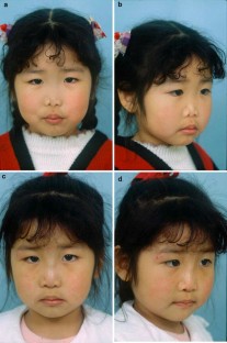 Surgical Management of Binder’s Syndrome: Lessons Learned | SpringerLink