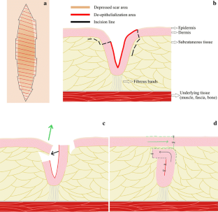 A New Technique for Correction of Tethered and Depressed Scars: Layered ...