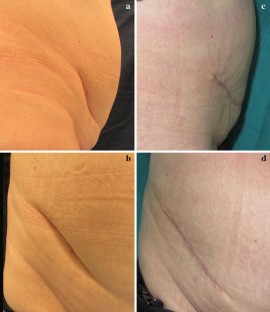A New Technique for Correction of Tethered and Depressed Scars: Layered ...