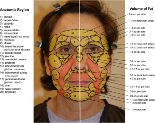 Facial Fat Grafting: Why, Where, How, and How Much | SpringerLink