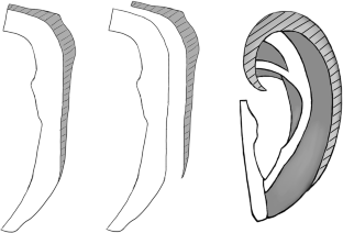 Aesthetic Auricular Reconstruction in Adult Patients with Rib Cartilage ...