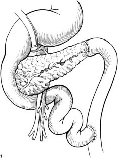 Lateral Pancreaticojejunostomy for Chronic Pancreatitis | SpringerLink