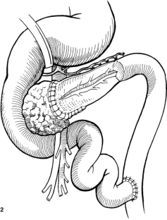 Lateral Pancreaticojejunostomy for Chronic Pancreatitis | SpringerLink