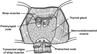 Modified Radical Neck Dissection for Differentiated Thyroid Cancer ...