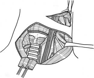 Modified Radical Neck Dissection for Differentiated Thyroid Cancer ...