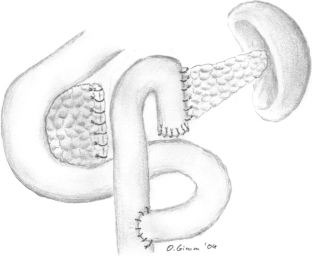 Surgery of Resectable Nonfunctioning Neuroendocrine Pancreatic Tumors | SpringerLink