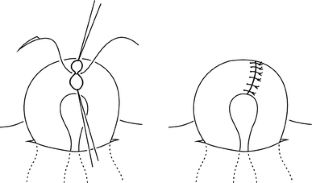 Loop Ileostomy Closure: Comparison of Cost Effectiveness between Suture ...