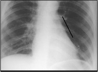 A Straight Left Heart Border: A New Radiological Sign of a ...