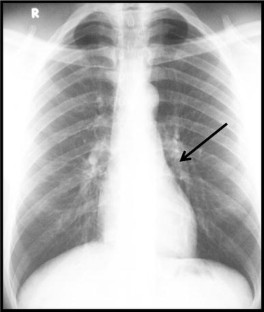 A Straight Left Heart Border: A New Radiological Sign of a ...