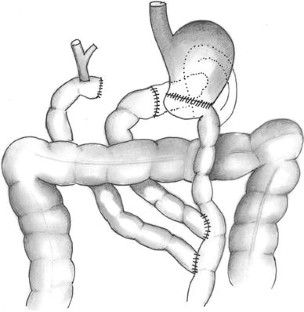 Single Versus Double Roux-en-Y Reconstruction Techniques in ...