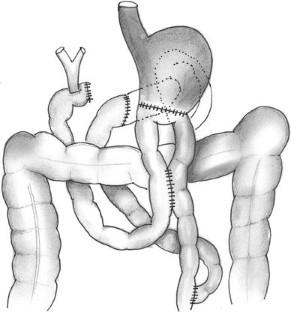 Single Versus Double Roux-en-Y Reconstruction Techniques in ...
