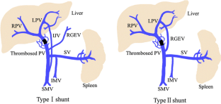 Evaluation of Rex Shunt on Cavernous Transformation of the Portal Vein ...