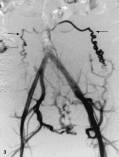 Ovarian Artery: Angiographic Appearance, Embolization and Relevance to ...