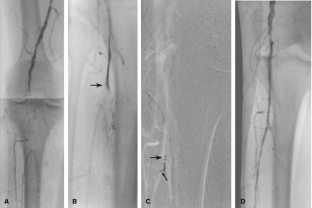 The Outback Catheter: A New Device for True Lumen Re-entry After ...