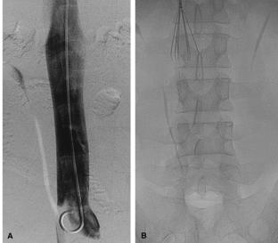 Temporary and Permanent Inferior Vena Cava Filter Combination in a ...