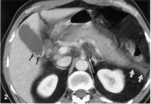 Acute Pancreatitis: The Role of Imaging and Interventional Radiology ...