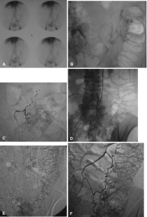 Microcatheter Embolization of Lower Gastrointestinal Hemorrhage: An Old ...