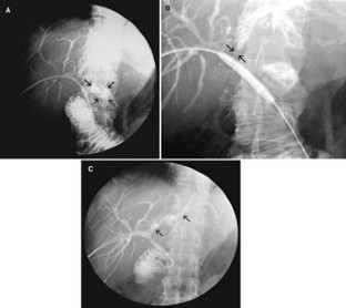 Percutaneous Transhepatic Biliary Drainage in the Management of ...