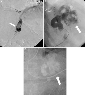Modified Balloon-Occluded Retrograde Transvenous Obliteration (BRTO ...
