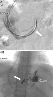 Modified Balloon-Occluded Retrograde Transvenous Obliteration (BRTO ...